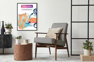 Plakat Ringworm vector illustration. Labeled fungal skin infection ...