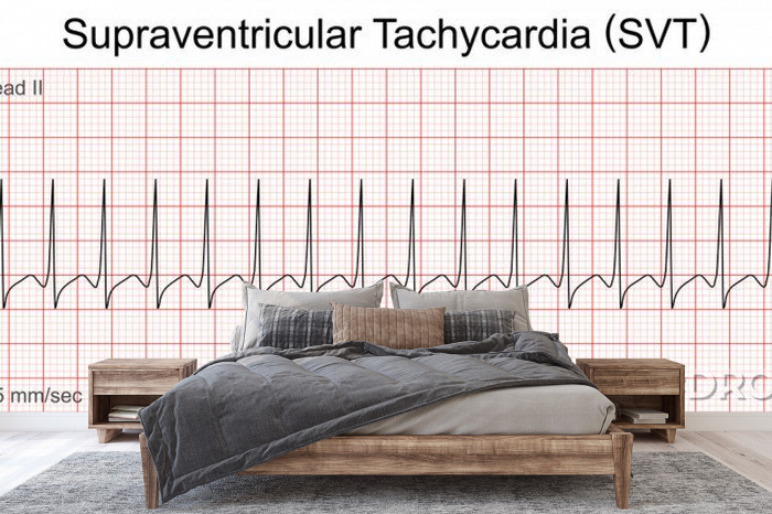 Naklejka Electrocardiogram show Supraventricular tachycardia (SVT ...